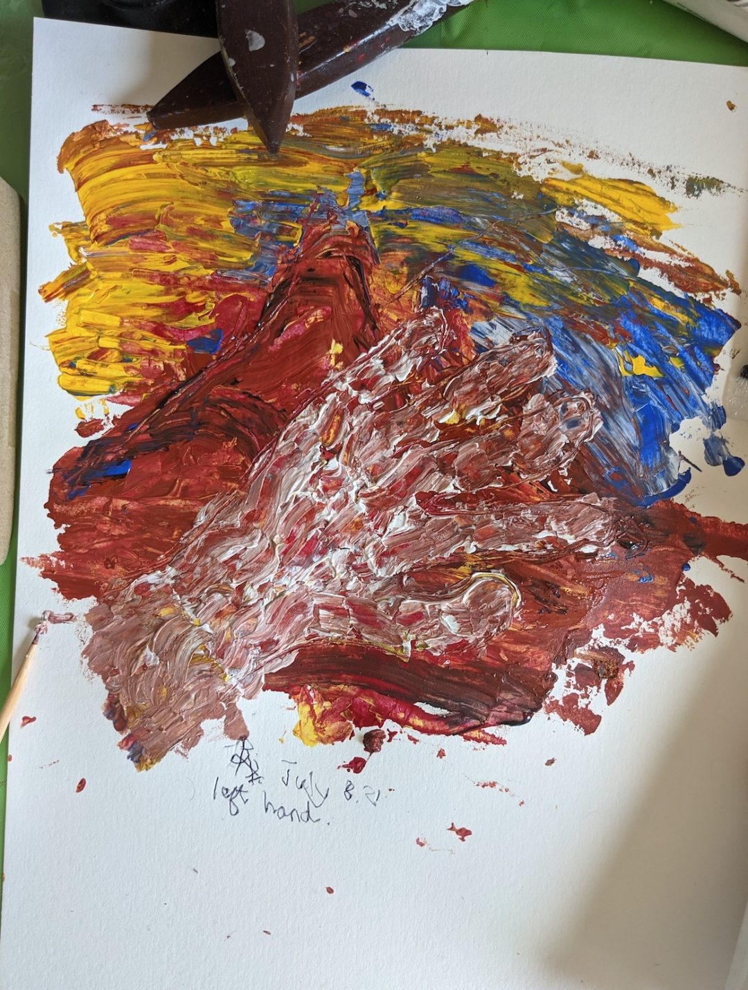 My Journey Exploring Medical Art Therapy for Burn Care: From Practice ...